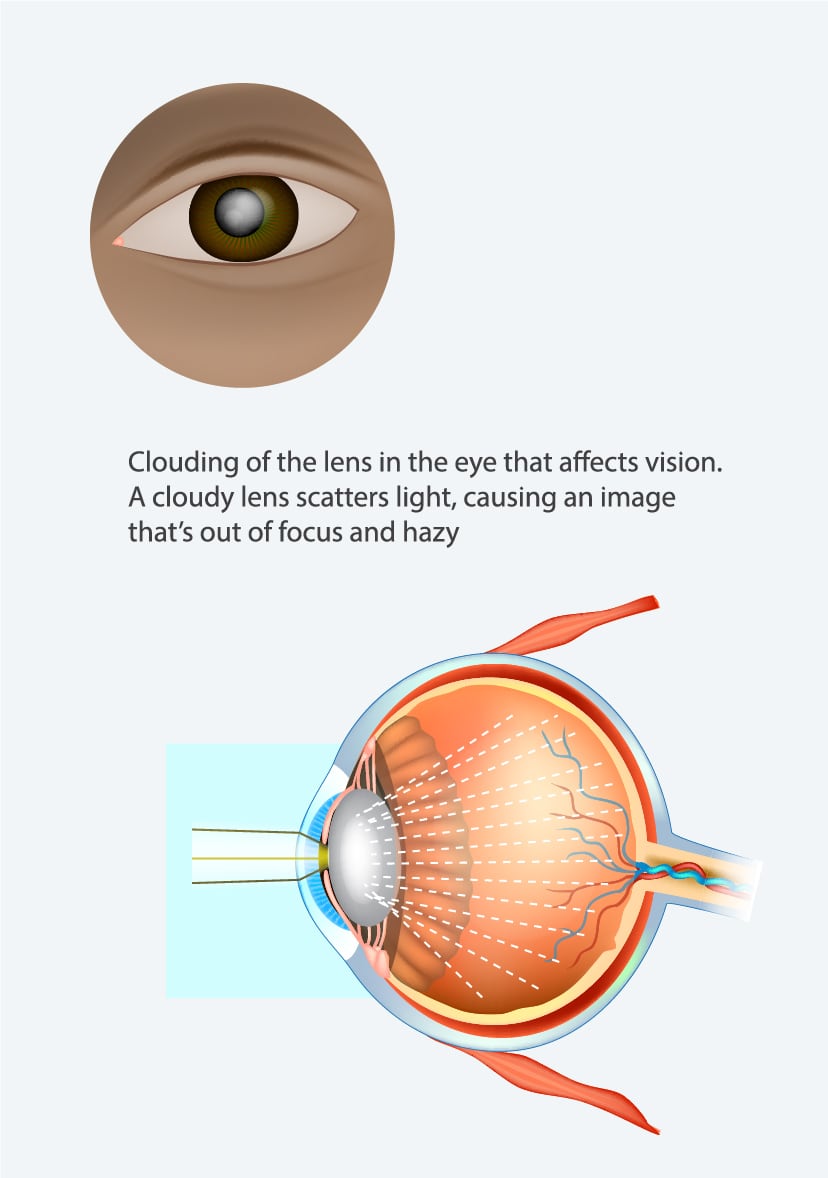 Cataract Surgery Sydney | Central Sydney Eye Surgeons