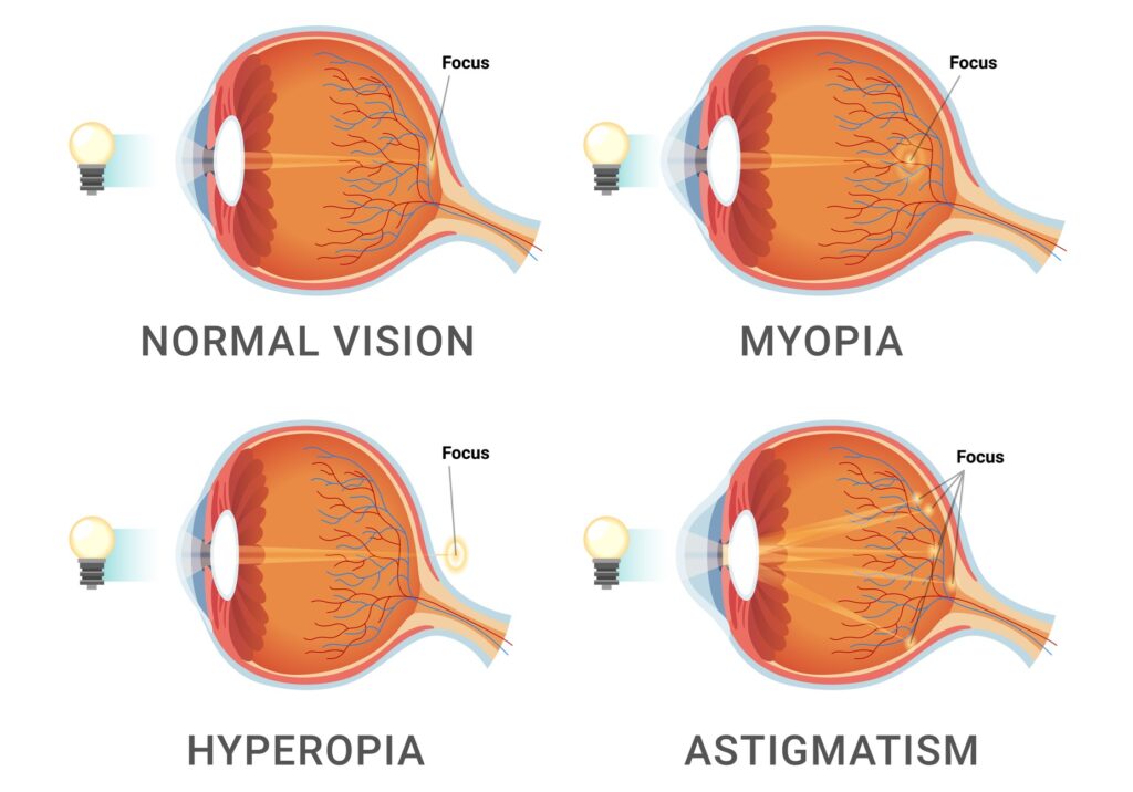 Refractive Laser Eye Surgery Sydney | Correct Blurry Vision